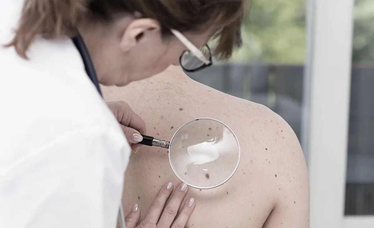 Can Topical Peptides Help with Skin Cancer Spots? What About Moles?